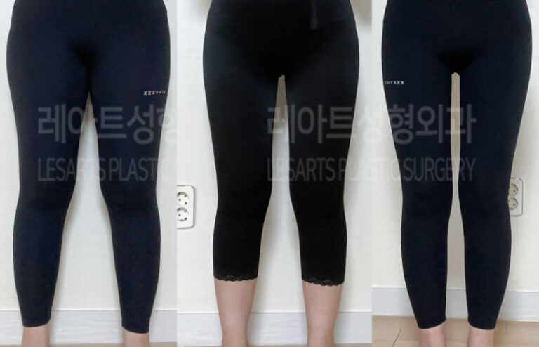 Thigh Liposuction Korea and Hip Line Liposuction – Safe and Effective ...
