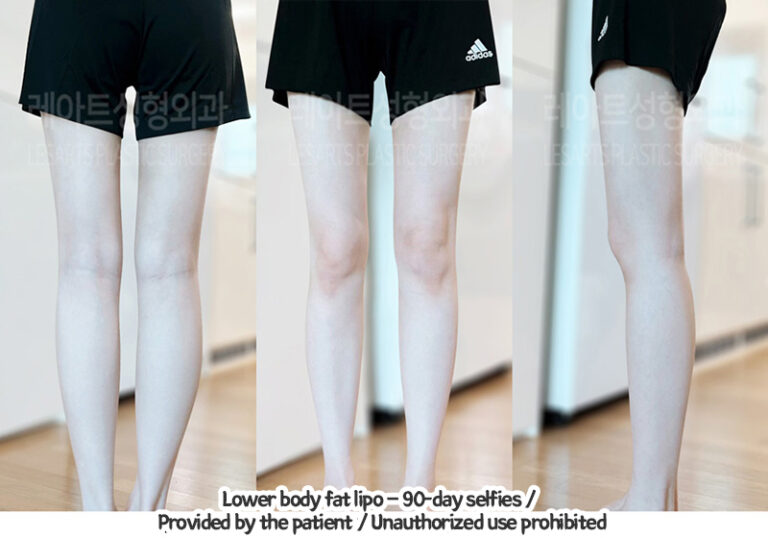 Thigh Liposuction Seoul: Slim Inner Thighs and Calf Line with Body ...